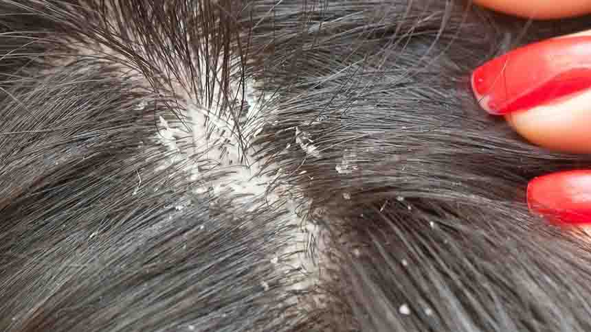 Dealing with dandruff in winter